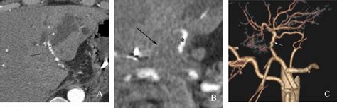 A 53 Year Old Male Patient With Hilar Cholangiocarcinoma Invading The