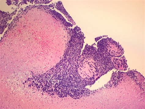 Pathology Outlines Intimal Sarcoma