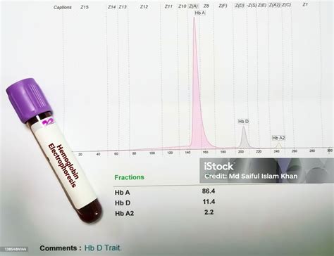Hemoglobin Electrophoresis Report With Blood Sample Showing Hemoglobin