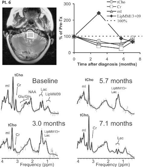 Serial Mr Spectroscopy Mrs Of Patient 6 Pt 6 Who Had Noticeably