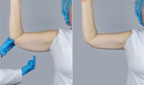 之前和之后 肱骨成形术 塑料手臂肘部悬着皮肤 一位年长的妇女向医生展示了 库存图片 图片 包括有 胶原 诊所 243585171