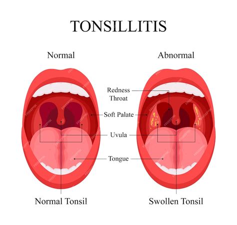Premium Vector Diagram Of Tonsillitis Causes Normal Tonsils And Swollen Tonsils