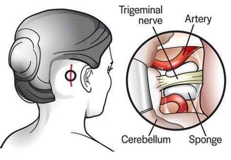 Cost Of Microvascular Decompression Mvd Surgery In Vimhans Primamed Hospital Neurosurgery