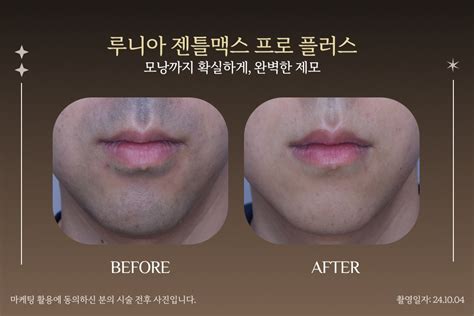 젠틀맥스 프로플러스 제모 루니아의원 산본점 Lunia Clinic