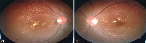 Unusual Course Of Interferon Related Retinopathy In Chronic Oman Journal Of Ophthalmology