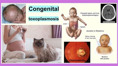 Toxoplasmosis