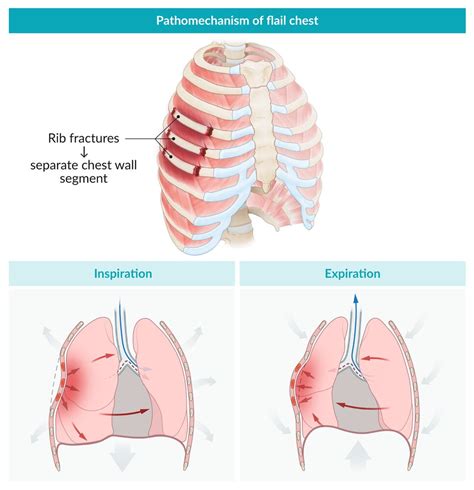Flail Chest Causes Symptoms Diagnosis Treatment 41 Off