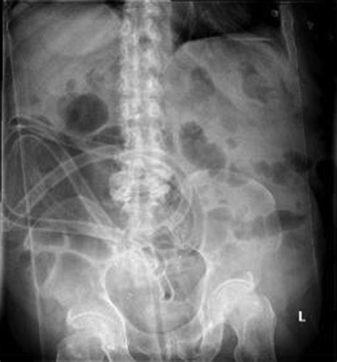 Sigmoid Volvulus Decompression