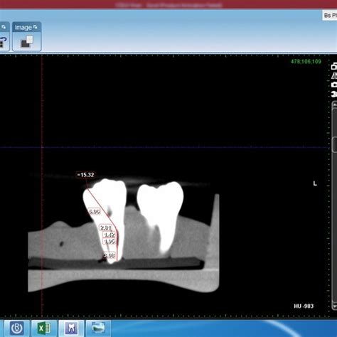 Romexis Viewer Measurement On The Conventional Cbct Software