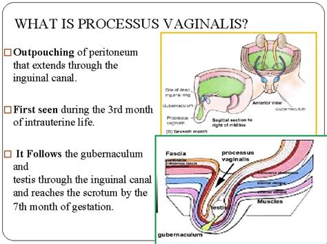 Congenital Hydrocele And Hernia Dr Enono Yhoshu Department