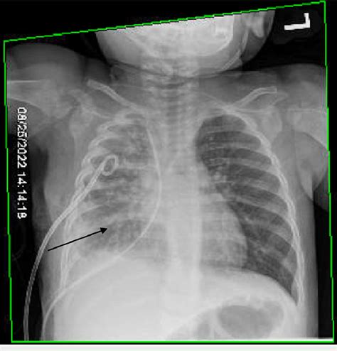 Chest X Ray Showing Right Sided Pleural Effusion Black Arrow