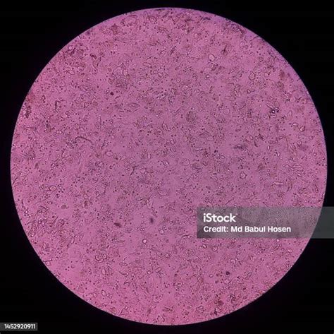 현미경 사진 광학 현미경으로 비정상적인 소변 분석의 근접 보기 상피 세포 고름 세포 적혈구 Uti 건강 검진에 대한 스톡 사진 및 기타 이미지 Istock