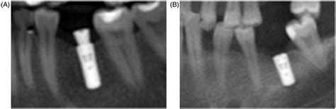 Twenty Tissue Level Platform Switching A And 20 Bone Level B Download Scientific Diagram