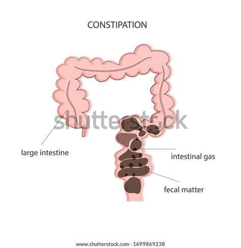 Fecal Obstruction Gas Accumulation Colon Medical Stock Vector Royalty