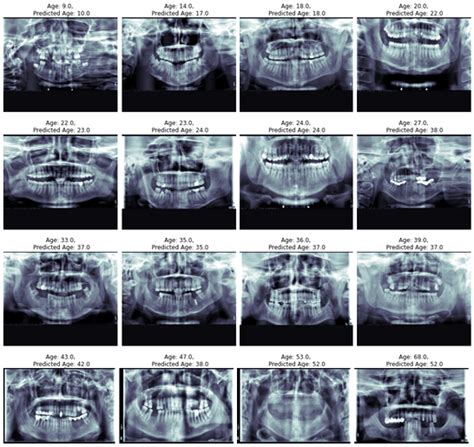 Age Estimation Detection Of Our Proposed Model On Different Dpr Images