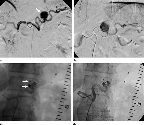 Splenic Arterial Embolization For A Splenic Artery Aneurysm Of Unknown Download Scientific