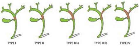 Hilar Cholangiocarcinoma Cross Sectional Evaluation Of Disease