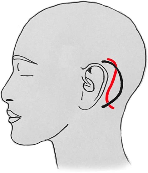 Retrosigmoid Approach Archives Neurosurgery Blog