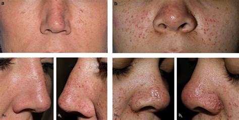 1 Tuberous Sclerosis Symptoms And Causes