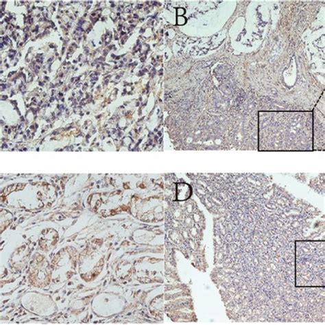 Comparative Analysis Of C Met Expression In Gc And Paracancerous Tissues Download Scientific