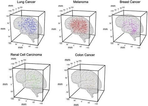 Use Of Predictive Spatial Modeling To Reveal That Primary Cancers Have Distinct Central Nervous