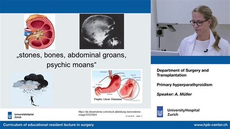 Primary Hyperparathyroidism Youtube
