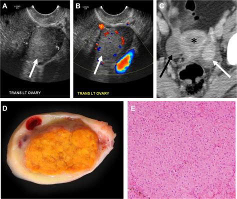 Sex Cord Stromal Tumors Of The Ovary Radiologic Clinics