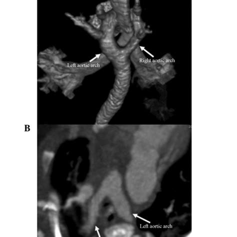Flow Volume Curve Showing A Variable Intrathoracic Airway Obstruction Download Scientific Diagram