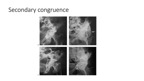 Acetabulum Fractures Anatomy Radiological Evaluation Classification And Management Pptx