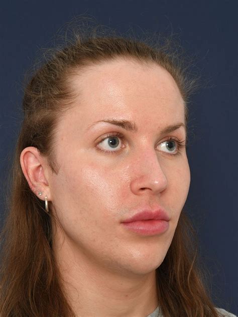 Eden Before And After Ffs 2pass Clinic