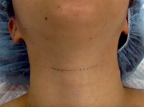 Isshiki Thyroplasty Type 2 Ent And Audiology News