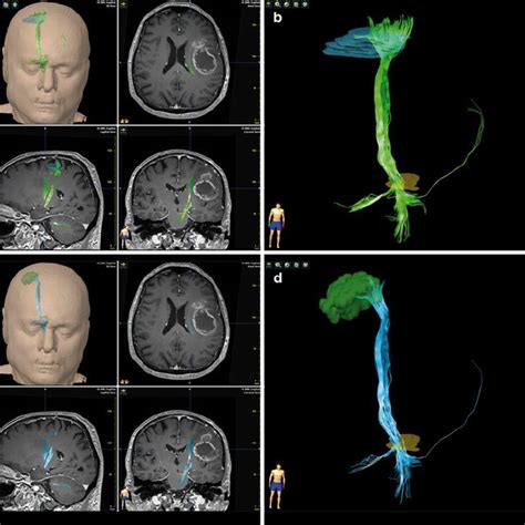 Pdf Diffusion Tensor Imaging Fiber Tracking Using Navigated Brain Stimulation A Feasibility