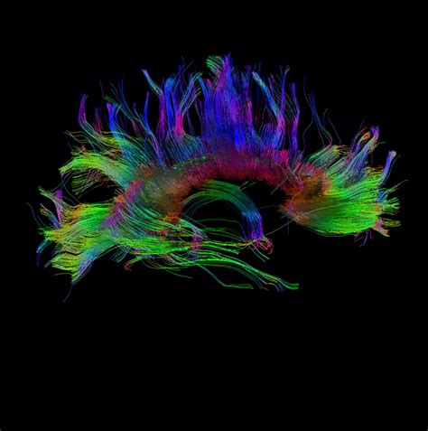 磁共振弥散张量成像技术 Dti：透视人类大脑的秘密 知乎