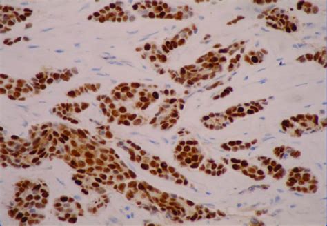 Immunohistochemical Detail Of The Primary Scalp Tumor Demonstrating Download Scientific