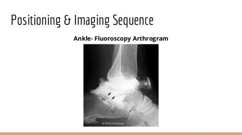 Arthrography Of The Shoulder Ankle And Wrist Pptx
