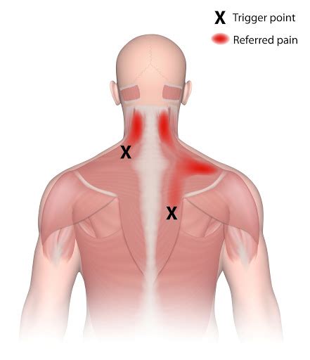 Ischemic Compression Technique Trigger Point Hypothesis Types And