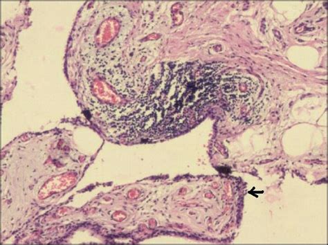Synovium With Focal Hyperplasia Of The Lining Epithelium Arrow Download Scientific Diagram