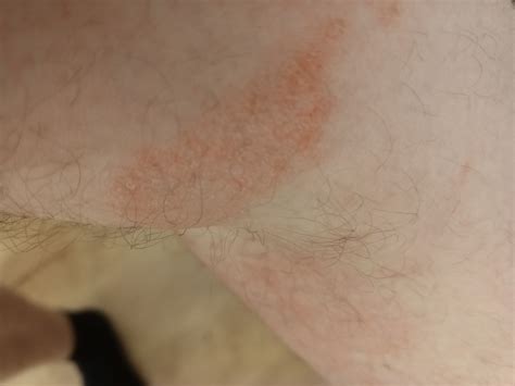 Красные пятна на теле С ноября появилмсь красные пятна на теле с шелушением Medaboutme