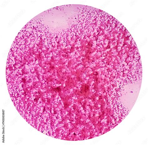 Fna Cytology Of Thyroid Swelling Thyroiditis Smear Show Cellular
