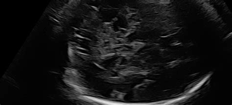 Coherence Based Sound Speed Aberration Correction — With Clinical Validation In Fetal Ultrasound