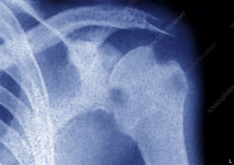 Tuberculosis In The Bones X Ray Stock Image C0027291 Science