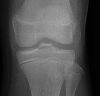 Tibial Spine Fracture Wikism Sports Medicine Wiki