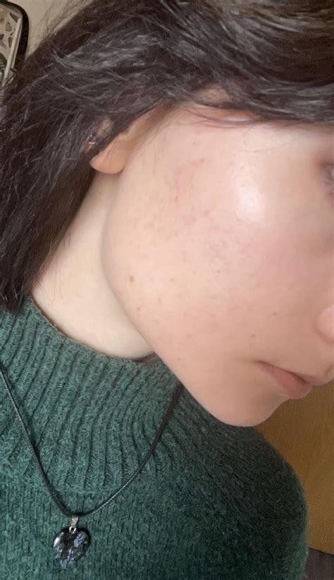 3mo On Doxycycline Bp And Clindamycin R Acne