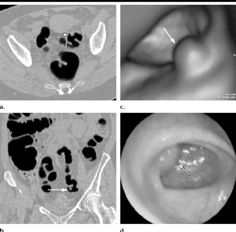 Seven Millimeter Diameter Polyp Arrow In 68 Year Old Woman A Download Scientific Diagram