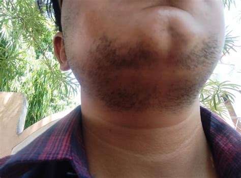 24 And Cant Grow Beard It Grows In Patches And Looks Ugly Af Any