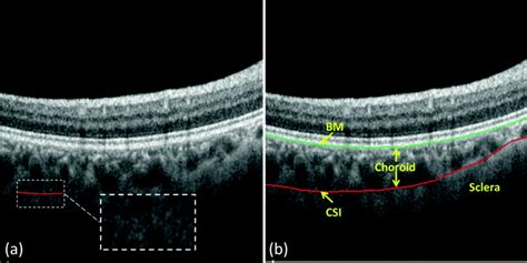 Illustration Of A Sample OCT B Scan And Its Choroid Layer Boundaries