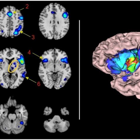functional connectivity map of ba44 by meta analytic connectivity download scientific diagram
