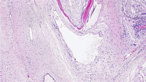 Pathology Outlines Cystic Trophoblastic Tumor