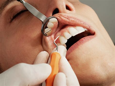 What Is Teeth Scaling And Root Cleaning Bridge Creek Dental