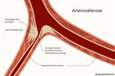 Arteriosklerose Symptome